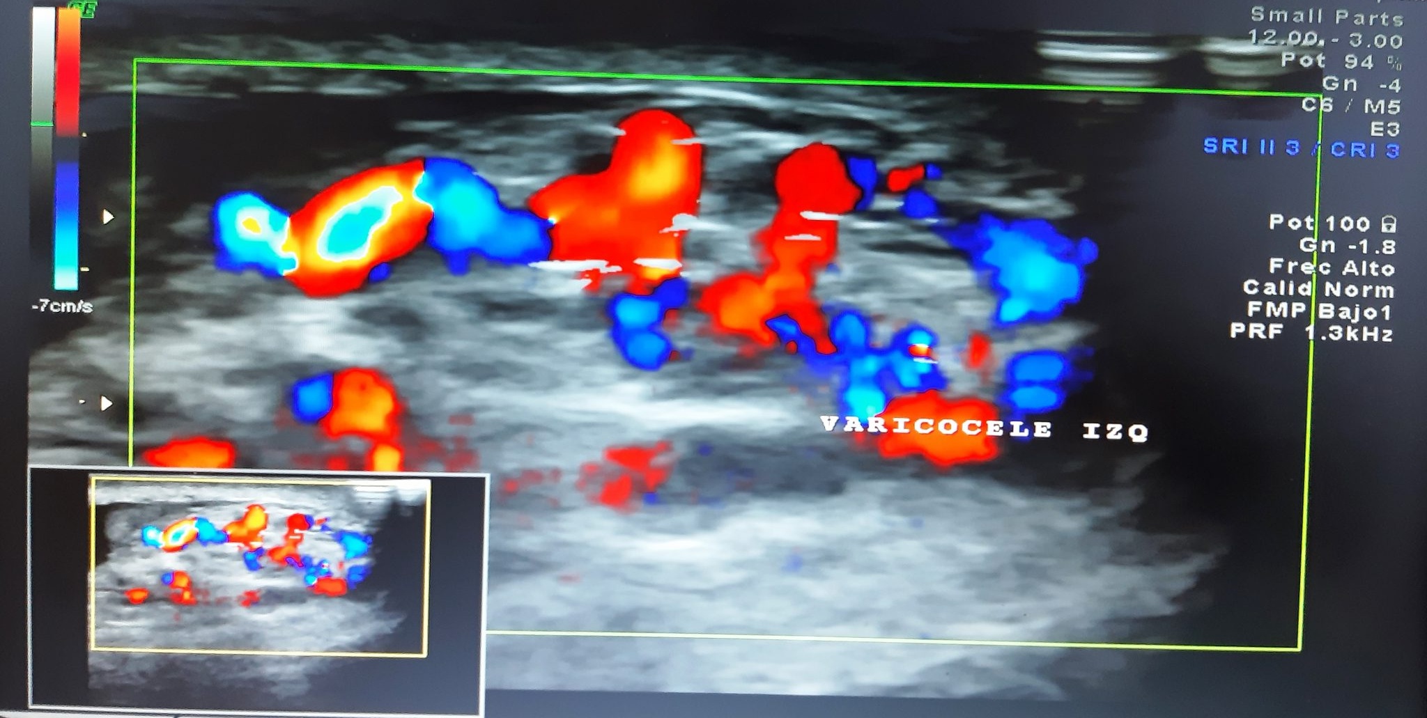 Varicocele - Diagnóstico por Imágenes San Sebastián