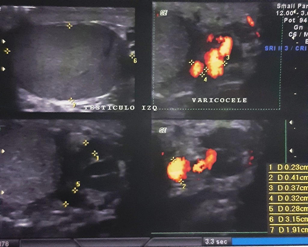 Varicocele - Diagnóstico por Imágenes San Sebastián